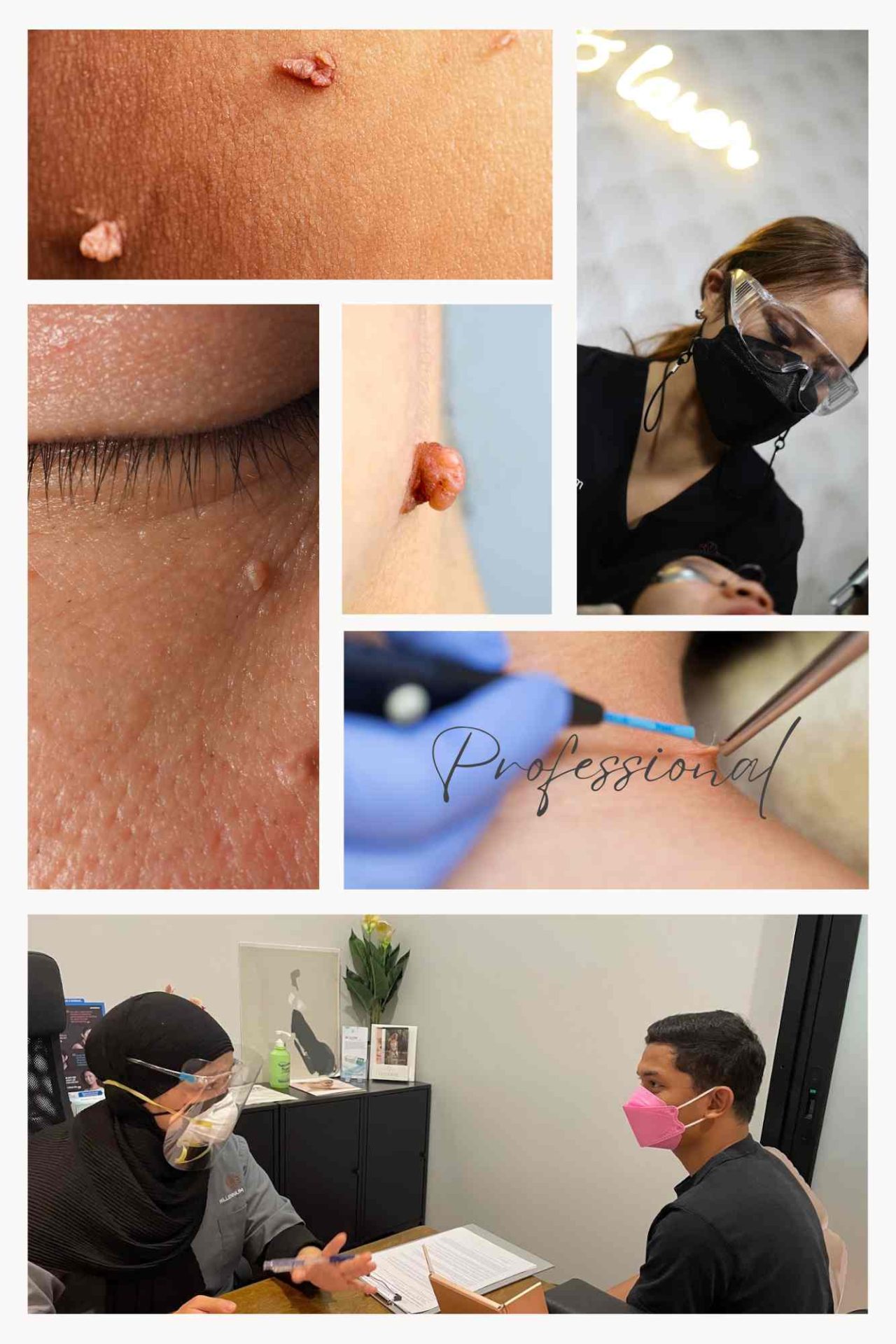 No.1 Skin Tag Removal in Kuala Lumpur & Malaysia