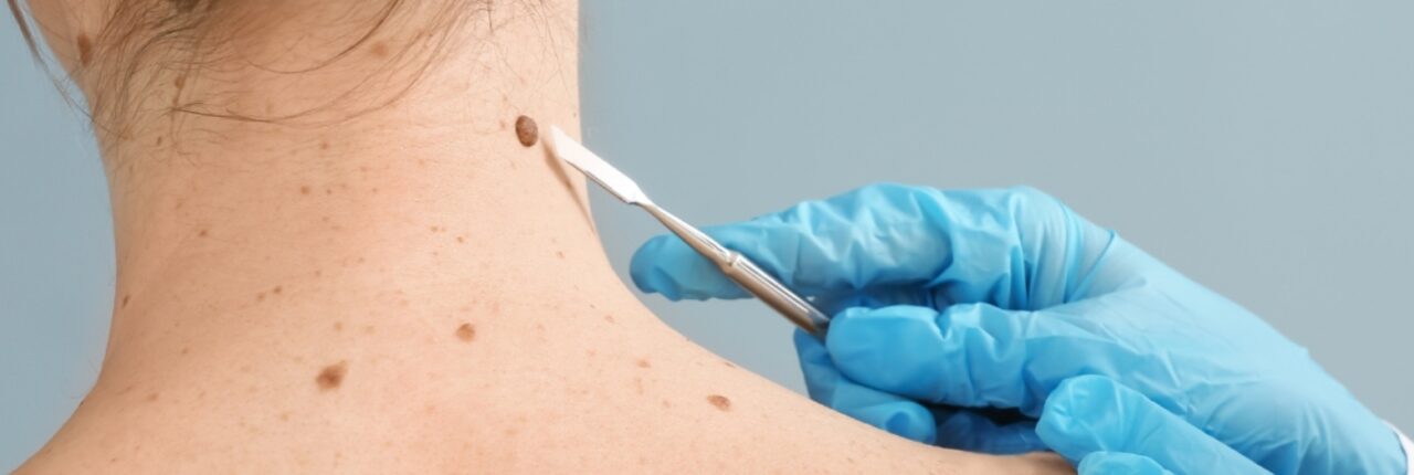 Skin Tag Treatment - Millennium Clinic KL
