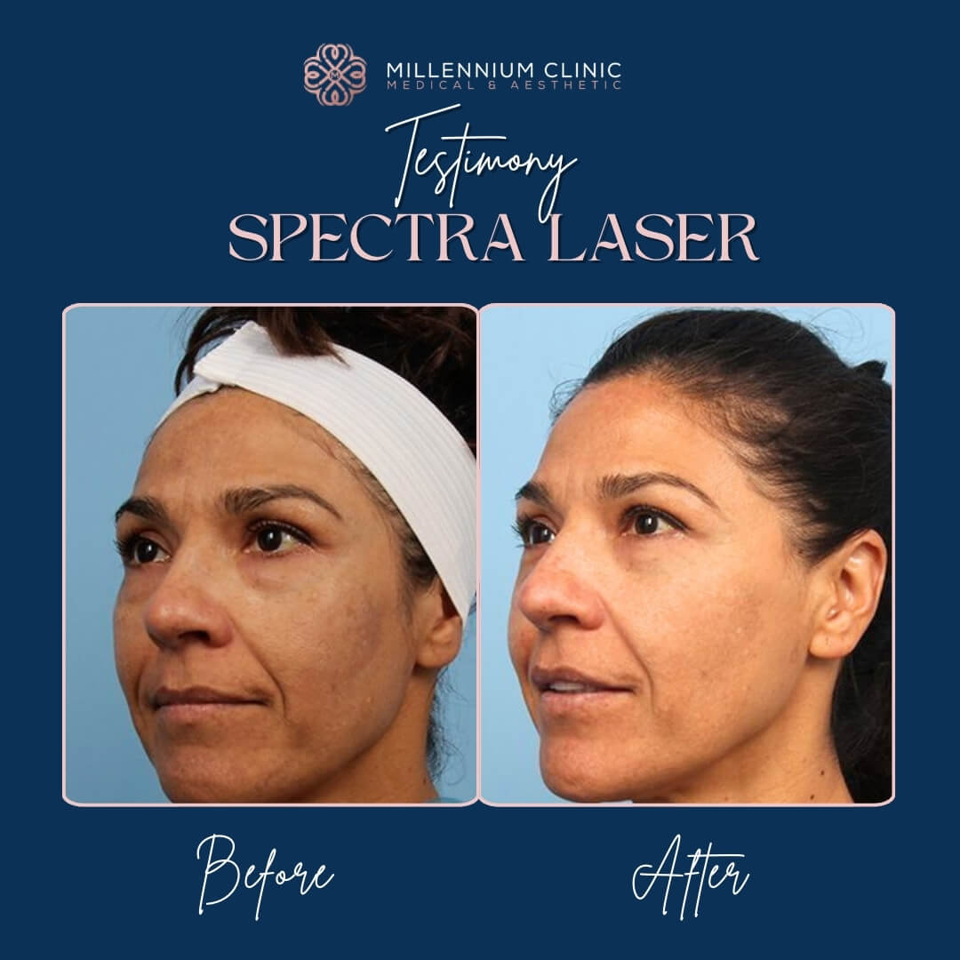 Spectra™ Laser - Millennium Clinic KL