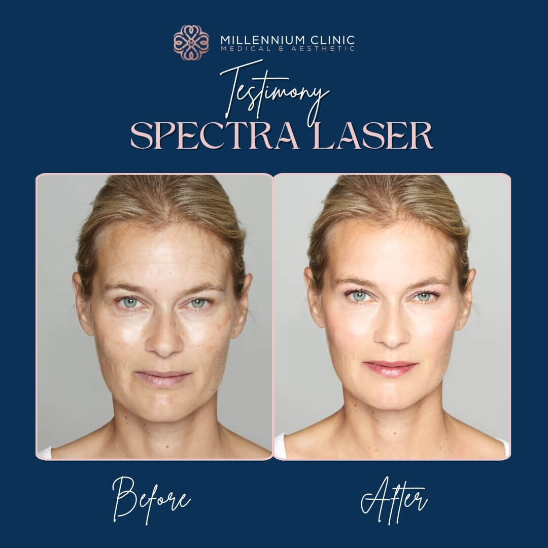Spectra™ Laser - Millennium Clinic KL