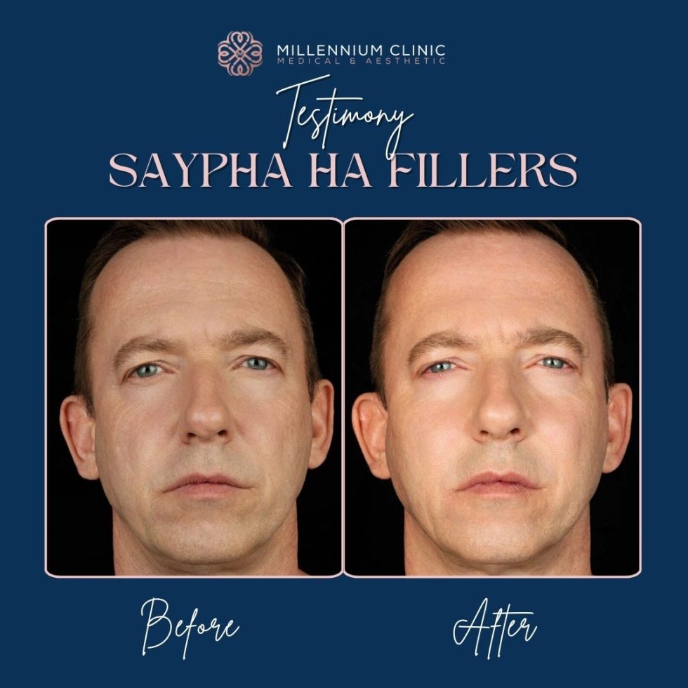 Saypha HA Filler - Millennium Clinic KL