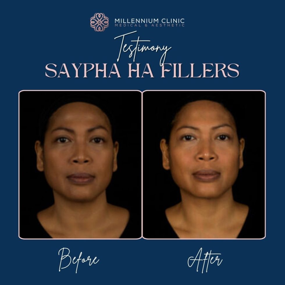 Saypha HA Filler - Millennium Clinic KL